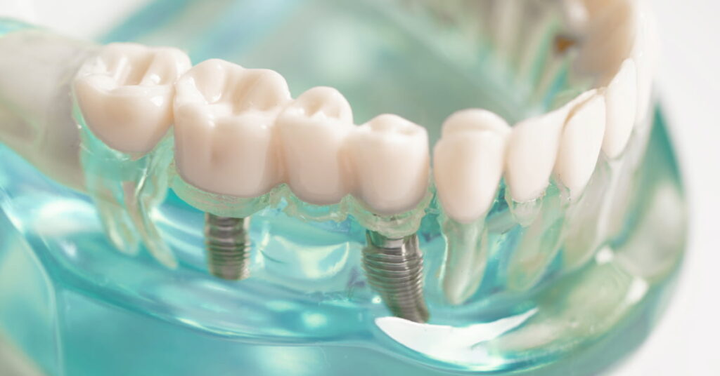 What Are Fake Teeth Called? – Dr Kaplansky