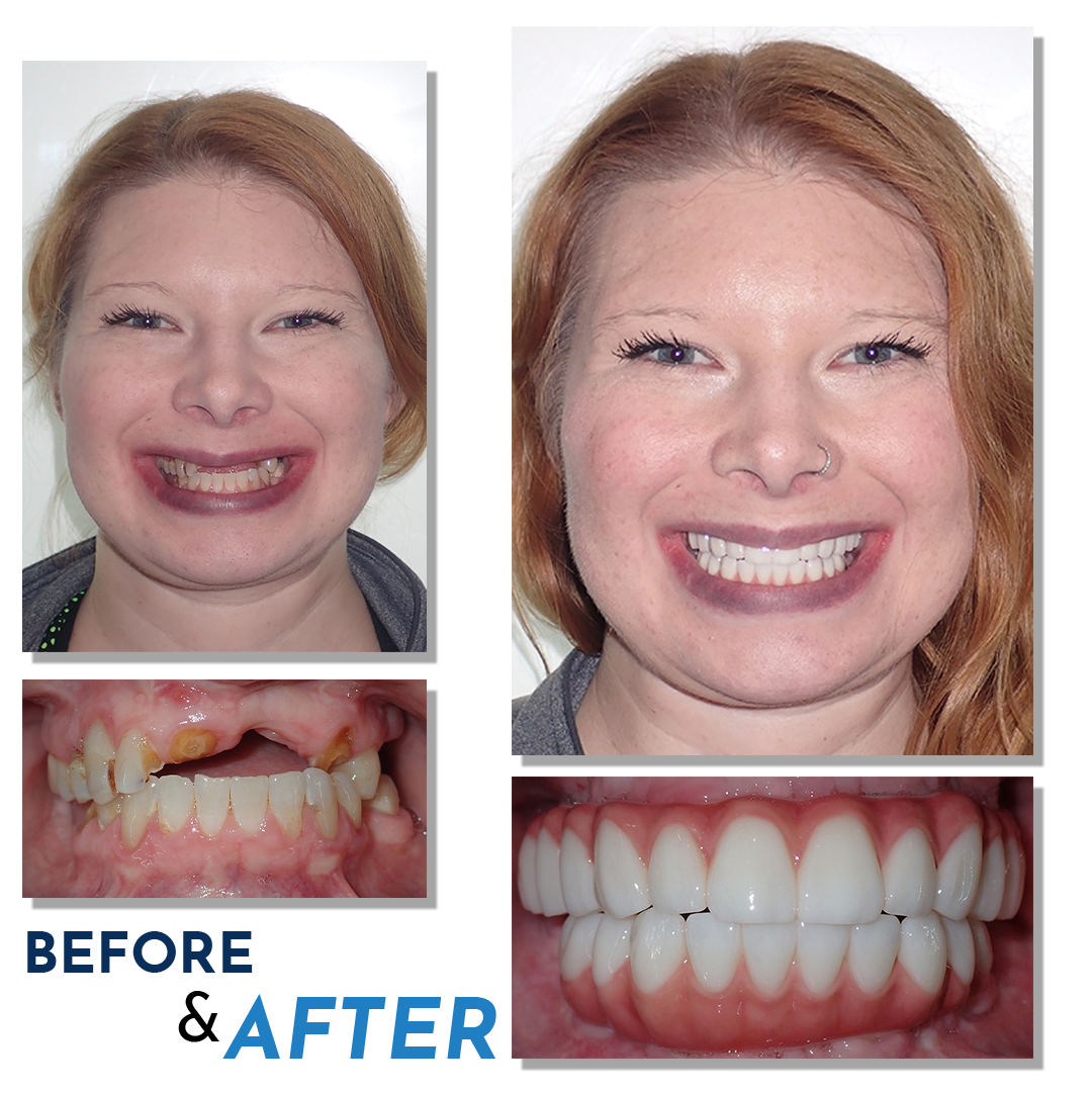 Before and After – Dr Kaplansky