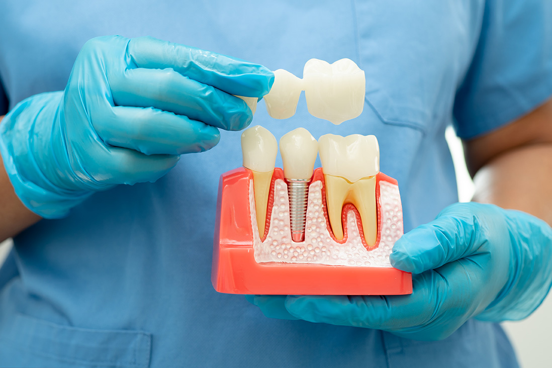 How to Treat Missing Teeth with Tooth Replacements – Dr Kaplansky