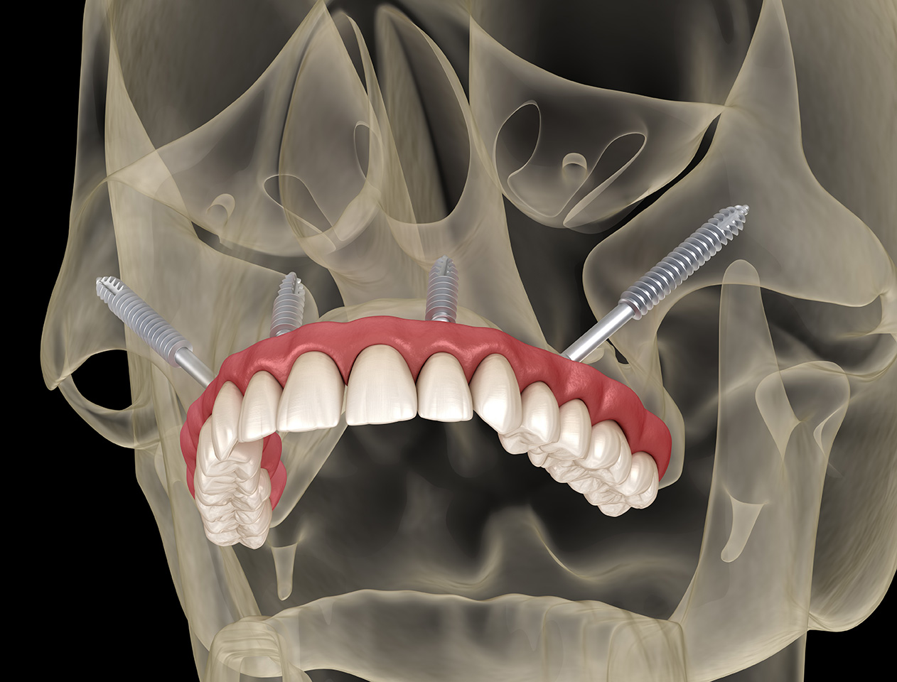 Zygomatic Implants: The Ideal Solution for Upper Jaw Tooth Loss – Dr ...
