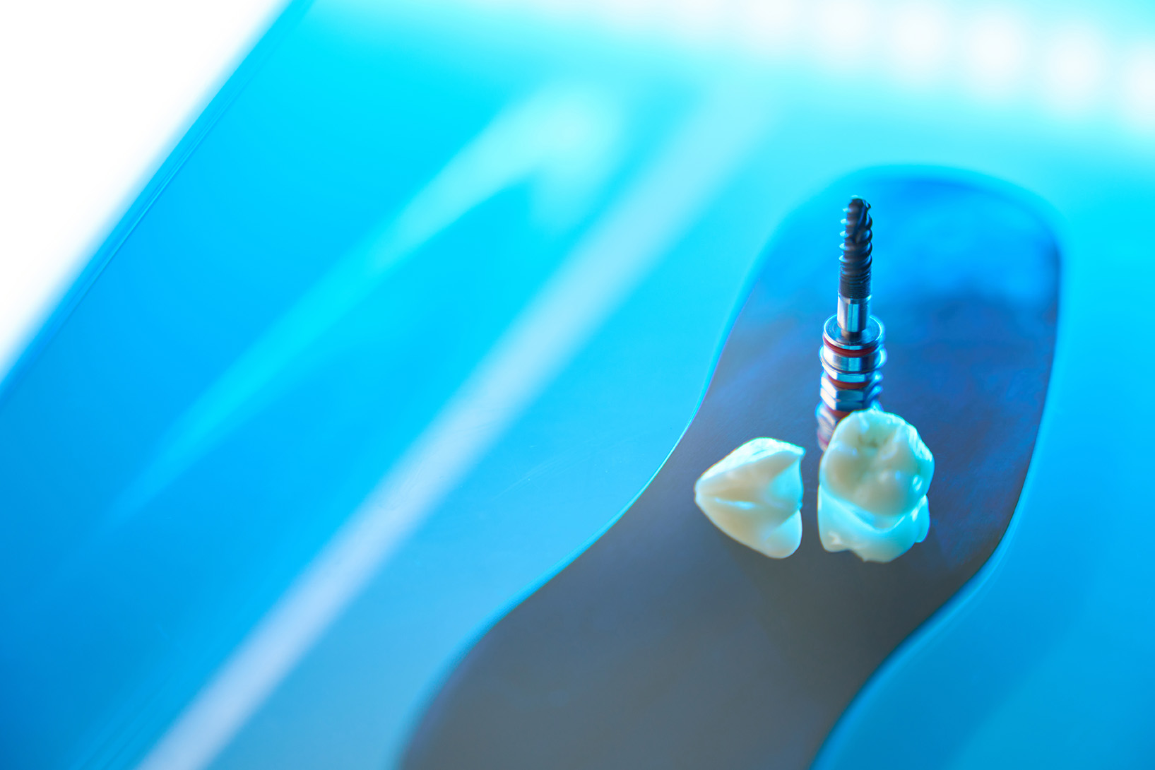 What Do Full Mouth Dental Implants Look Like in Real Life? – Dr Kaplansky